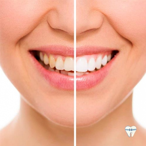 Dentística e Estética dental | Felipe Odontologia